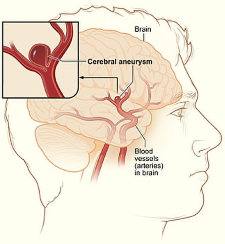 ICD-10-PCS Root Operation Selection For Treatment of Cerebral Aneurysms